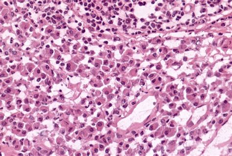 Stromal Giant Cells Mast Cells Neutrophils Multinucleate Plasma Cells Pathology