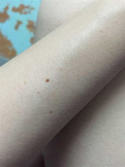 身上痣越來越多是怎麼回事？這是癌變的徵兆嗎？ 每日頭條