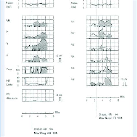 Indeterminate Microvolt T Wave Alternans In An Ischemic Implantable