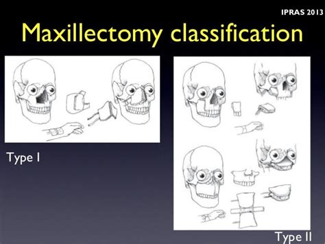 Reconstruction Post Oncologic Maxillectomy Ipras