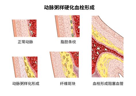 关于《动脉粥样硬化》的学习分享 知乎