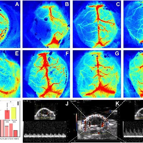 Monitoring Using Laser Speckle Blood Flow Imaging System And The