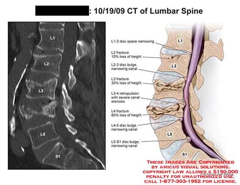 Amicus Illustration Of Amicus Radiology Ct Lumbar Spine L1 L2 L3 L4 L5