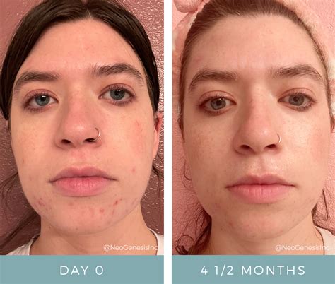 Cystic Acne Chin Treatment