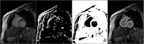 Table 1 From Quantification Of Right And Left Ventricular Function In Cardiac Mr Imaging