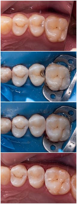 Foto De Antes E Depois Da Imagem Para Restauração Composta Dentária E
