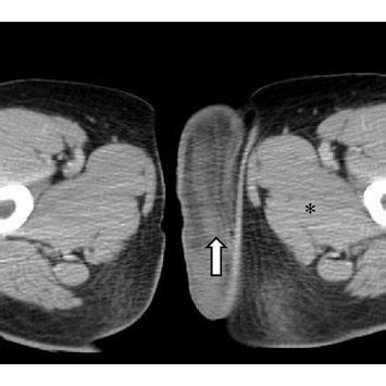 A Axial Noncontrast CT Image Showing Vulvar Skin Edema Arrow And Download Scientific