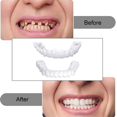 Smile Snap On False Teeth Upper Lower Dental Veneers Dentures Tooth