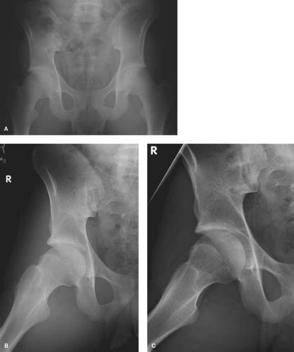 Femoroacetabular Impingement Overview Musculoskeletal Key