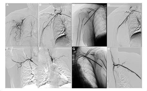 Rotarex Thrombectomy Combined With Drug Coated Balloon Dilation In Download Scientific Diagram