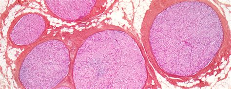 Nerve Biopsy
