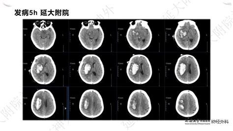监测有道丨电磁导航引导下大量脑出血神经内镜下血肿清除术——颅脑创伤 神经重症周刊（第316期） 脑医汇