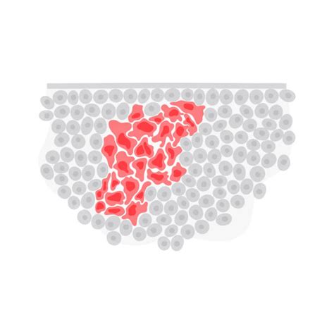 Best Benign Tumor Illustrations Royalty Free Vector Graphics And Clip