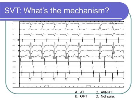 PPT Differential Diagnoses Of SVT Common EP Lab Techniques PowerPoint Presentation ID 5488742
