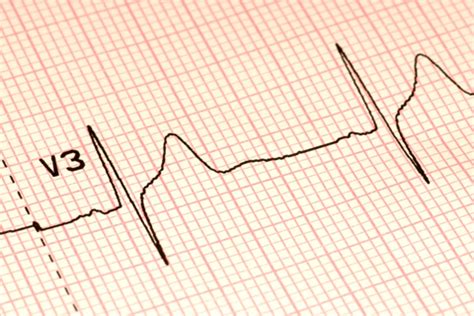 ECG Stockton EKG CA Electrocardiogram 95204 Stockton Cardiology