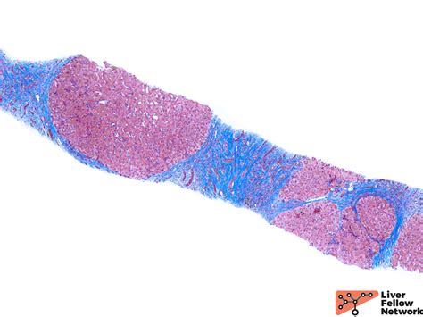 Pathology Pearls Hereditary Hemochromatosis Aasld
