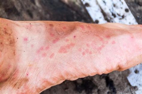 Bug Bite Vs Staph Infection