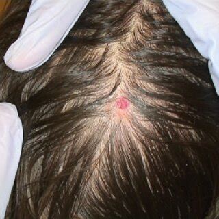 A Anterior Posterior Folding Of The Scalp Patient 1 B Download Scientific Diagram