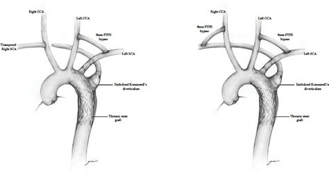 Diagram Representing Hybrid Supra Aortic Debranching Tevar And