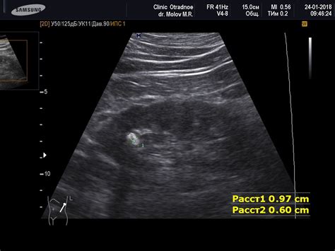 Kidney Stone Kidney Stones Kidney Stone