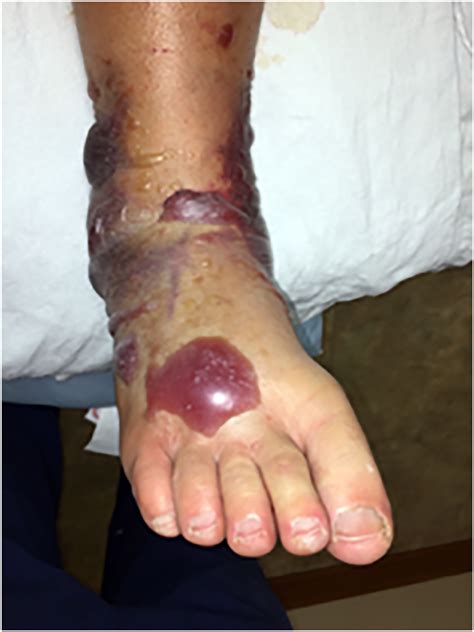 Management Of Pilon Fractures Clinics In Podiatric Medicine And Surgery