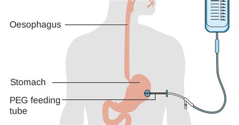 G Tube Feeding Guidelines At Jessica Crawford Blog