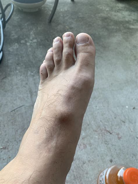 Weird Bump On Top Of Foot Store