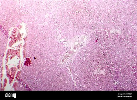 Acute Hepatic Congestion Light Micrograph An Acute Consequence Of