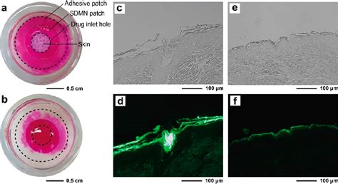 Figure 1 From A Semi Dissolving Microneedle Patch Incorporating Tempo