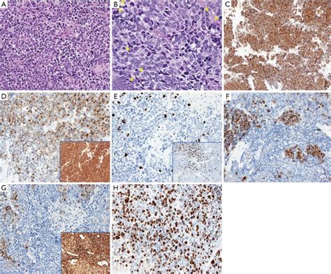 Classification Of Pulmonary Neuroendocrine Tumors New Insights Pmc