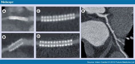 Deciphering The Role Of Cardiac Computed Tomography Page
