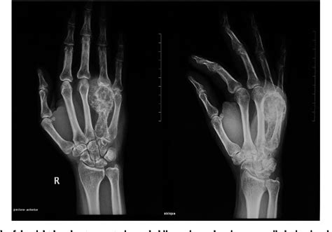 Chondrosarcoma Of Metacarpal A Rare Presentation Semantic Scholar