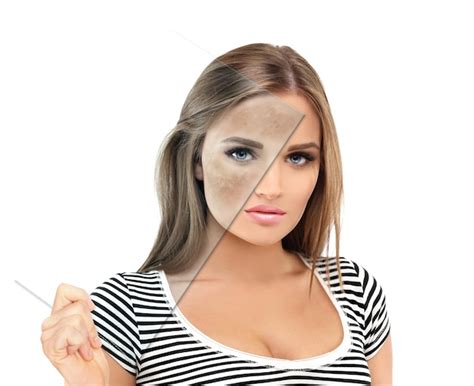 Premium Photo Dark Spots Hyperpigmentation Melasma Or Chloasma