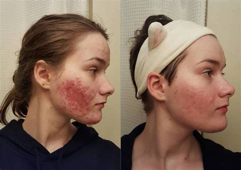 Does Accutane Work Popsugar Beauty