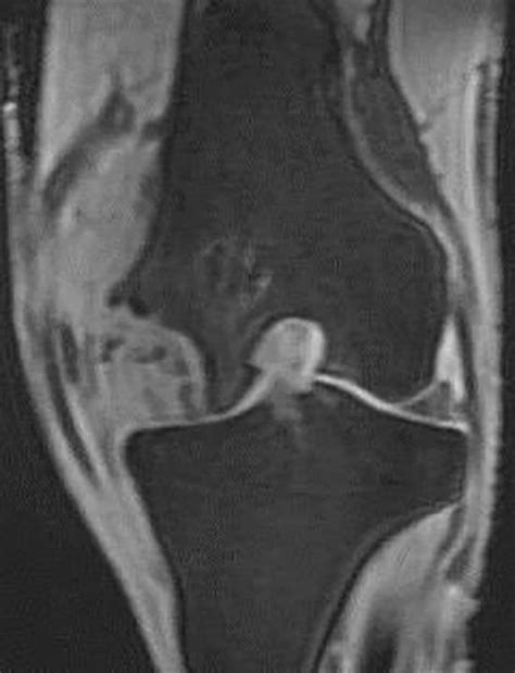 Dorsal Coronal T1 Fame Fast Acquisition With Multiphase Elliptical