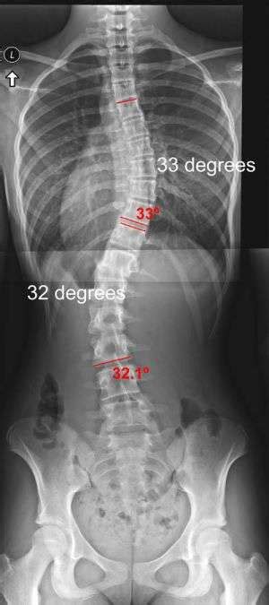3 Things You Didnt Know About Scoliosis Align Therapy Clinic In Lehi