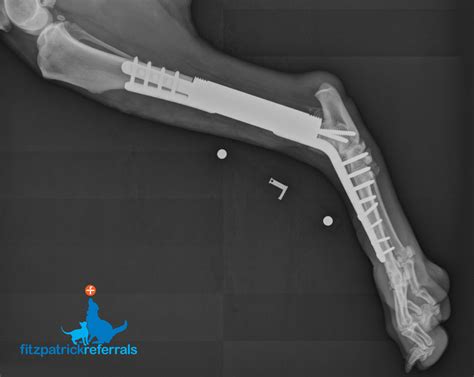 Tibial Endoprosthesis For Bone Cancer Fitzpatrick Referrals
