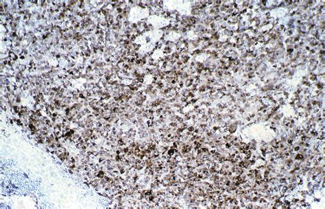 Ema Stain Ema Epithelial Membrane Antigen Download Scientific Diagram