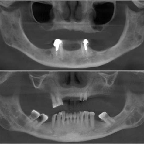 Axial Reconstruction On Cone Beam Computed Tomography Showing Cortical Download Scientific