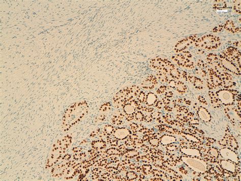 Immunohistochemical Staining For Pax8 Showing Strong Nuclear Positivity