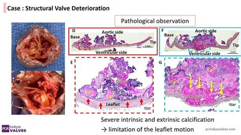Imaging Aortic Valve