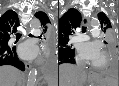 Left Atrium Size Heart