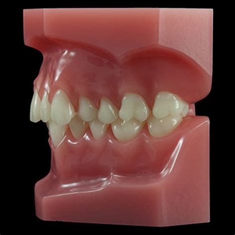 Or 07a Malocclusion Seriesclass I Crowded Hard Base Paradigm