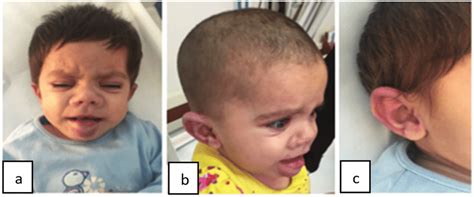 Facial Dysmorphic Features Depressed Nasal Bridge Saddle Nose Wide