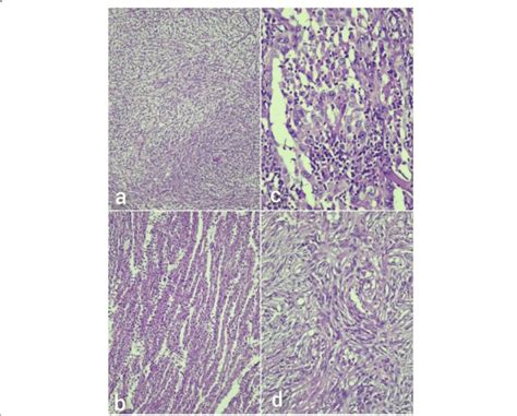 A Spindle Cell Proliferation Against Myxoid Stroma B With Areas