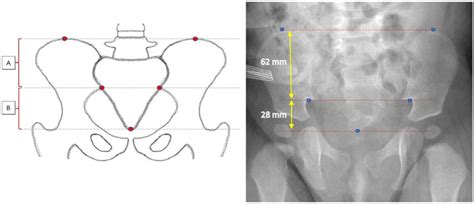 Anorectal Malformations And Late Term Problems PMC