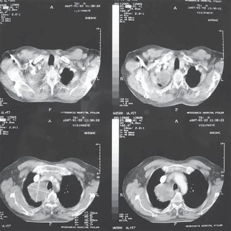 Pdf Ectopic Mediastinal Thyroid Gland A Case Report And Review Of The Literature