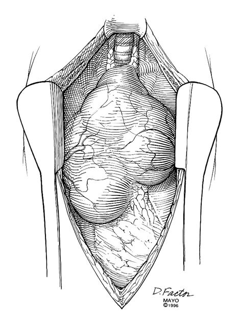 Transsternal Thymectomy