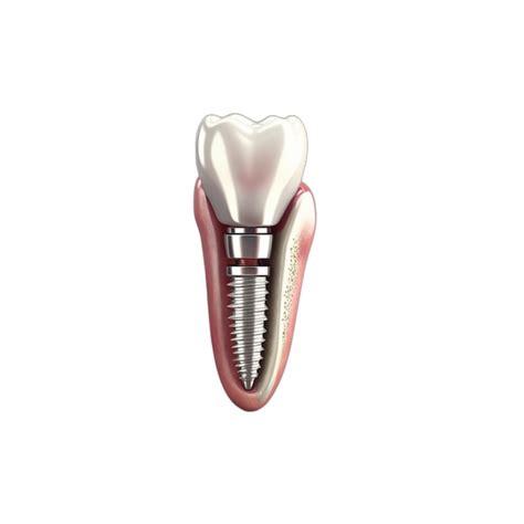 Implante Dental Implante Dental Vector Premium Generado Con Ia