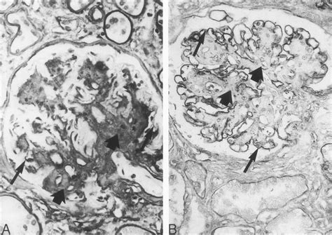 Bm Components In Diffuse Glomerulosclerosis The Enlarged Mesangial